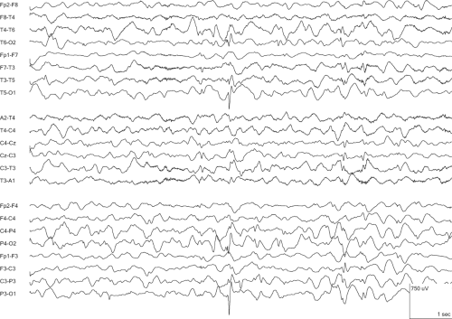 Lambda Waves Neupsy Key