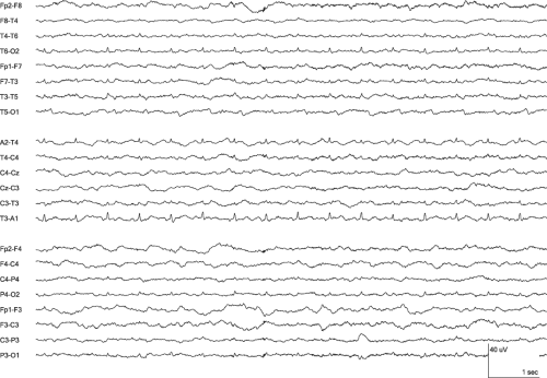 Lambda Waves Neupsy Key