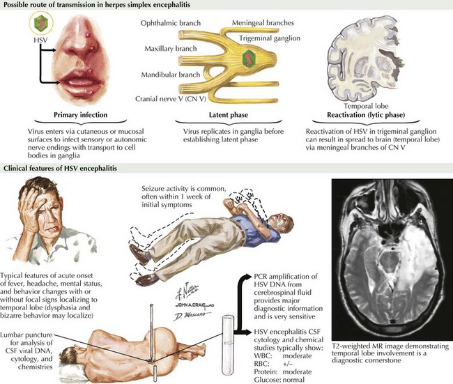 Signs And Symptoms Of Herpes Simplex Virus Encephalitis Infoupdate