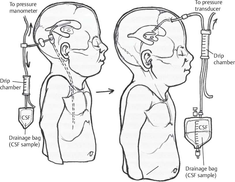 Ventriculoperitoneal Shunt Revision Neupsy Key Ventriculoperitoneal Shunt Revision Neupsy Key