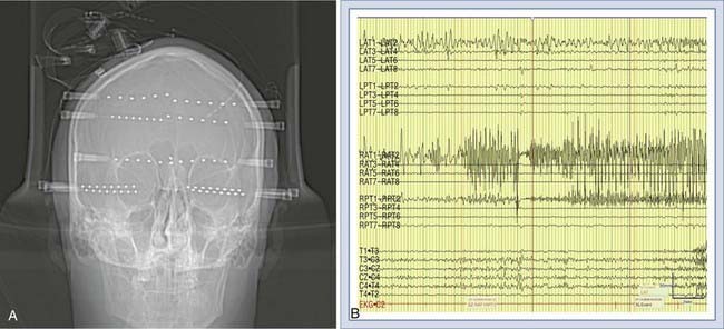 Evaluation Of Patients For Epilepsy Surgery Neupsy Key