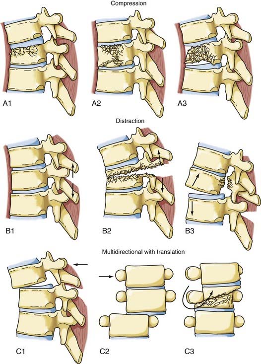 Lumbar Fracture Types Images Photos Mungfali Lumbar Fracture Types Images Photos Mungfali