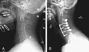 Traumatic Asymptomatic Vertebral Artery Injury Secondary To Facet