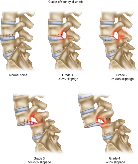 Spondylolisthesis Neupsy Key