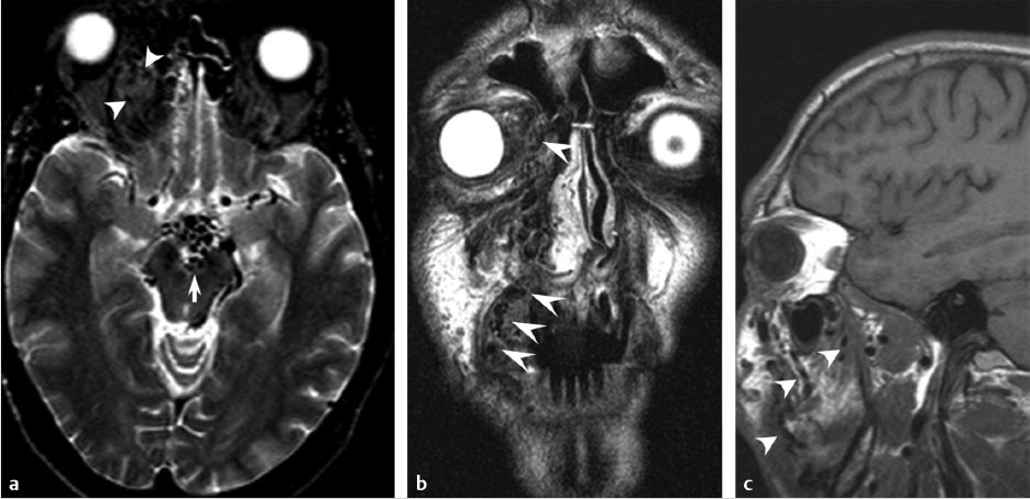 Syndromic Arteriovenous Malformations Neupsy Key