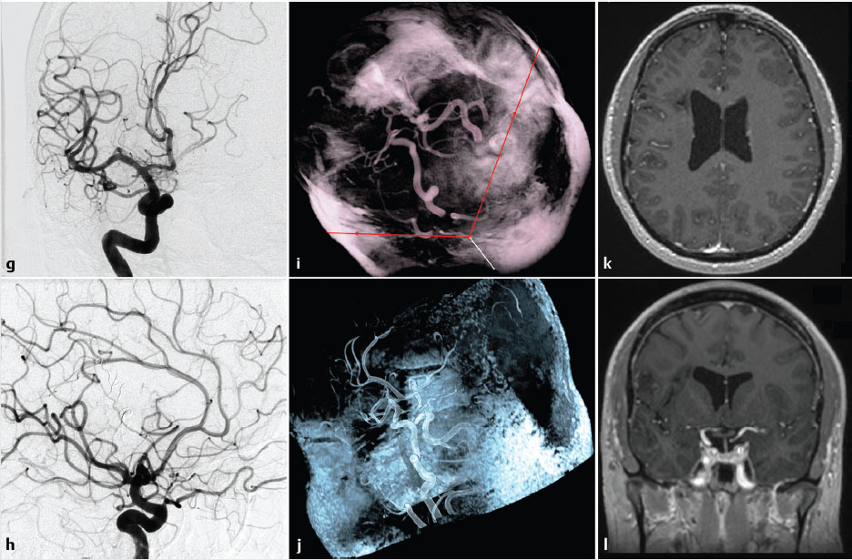 Stereotactic Radiosurgery For Brain Arteriovenous Malformations