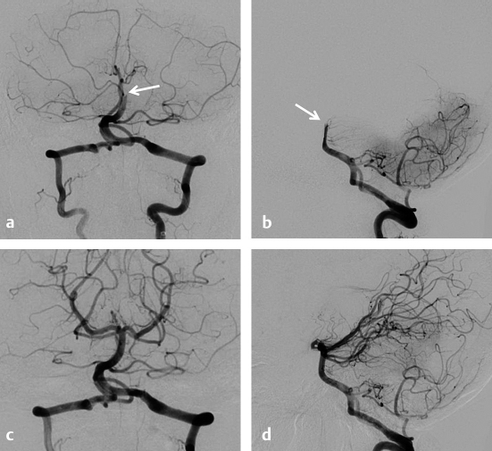 23 Brainstem Ischemia Stroke And Endovascular Revascularization Of