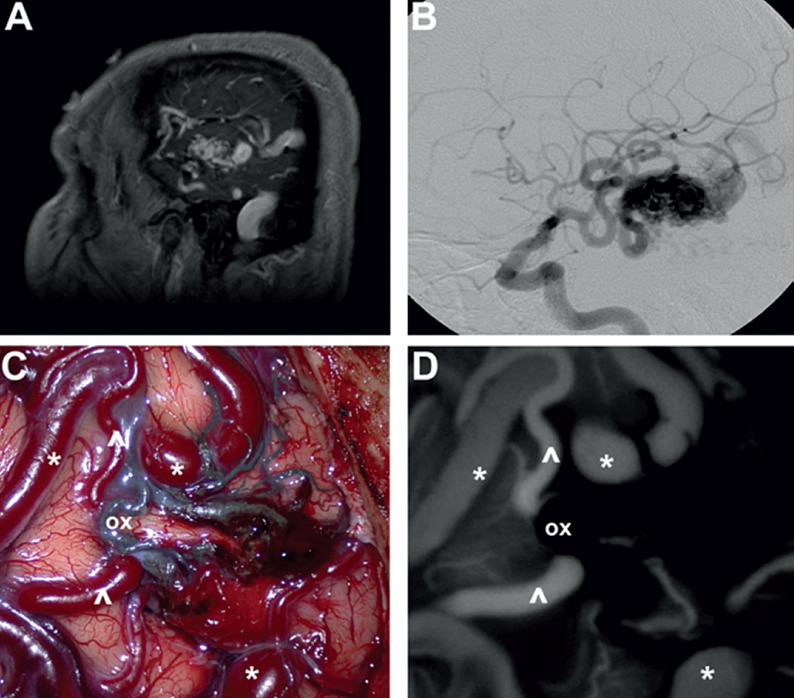 Surgical Management Of Intracranial Arteriovenous Malformations