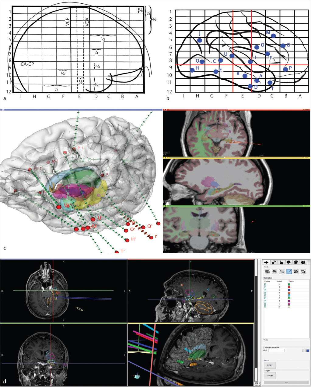 1 Collaborative Planning In Epilepsy Surgery Neupsy Key