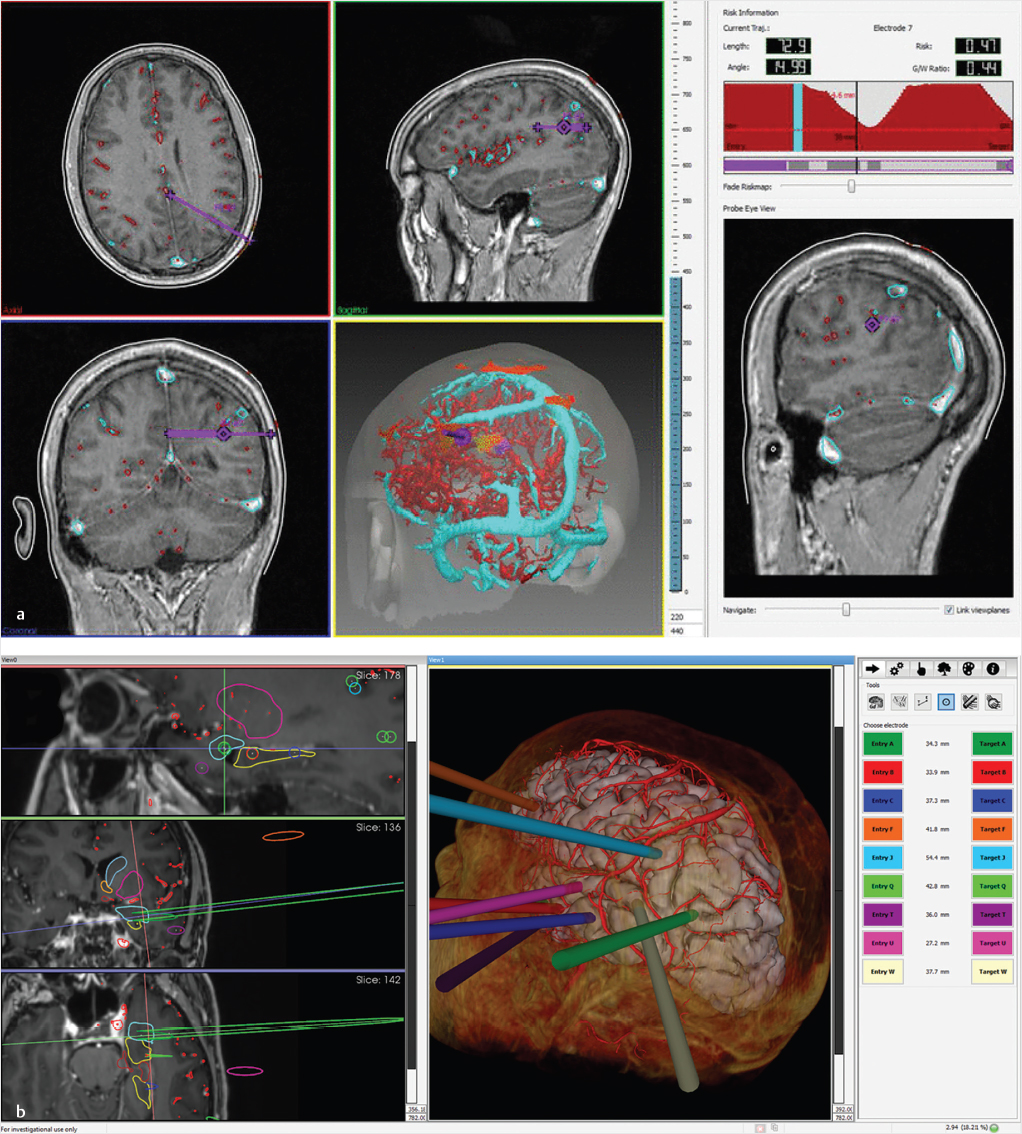 1 Collaborative Planning In Epilepsy Surgery Neupsy Key