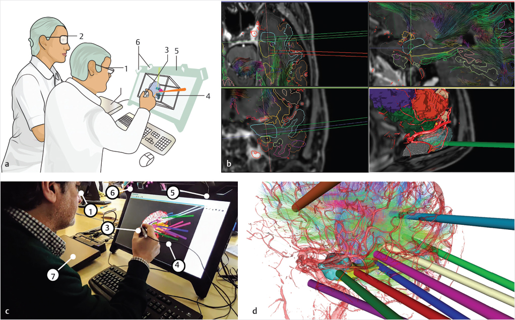 1 Collaborative Planning In Epilepsy Surgery Neupsy Key