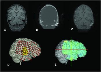 Chapter 9 – Multimodality image coregistration for MRI-negative ...