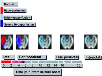Chapter 5 – Advanced SPECT image processing in MRI-negative refractory ...