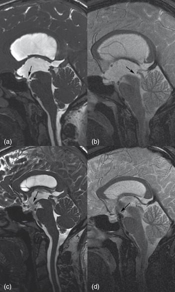 19 – Endoscopic third ventriculostomy | Neupsy Key