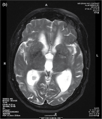 10 – The differential diagnosis of normal pressure hydrocephalus ...