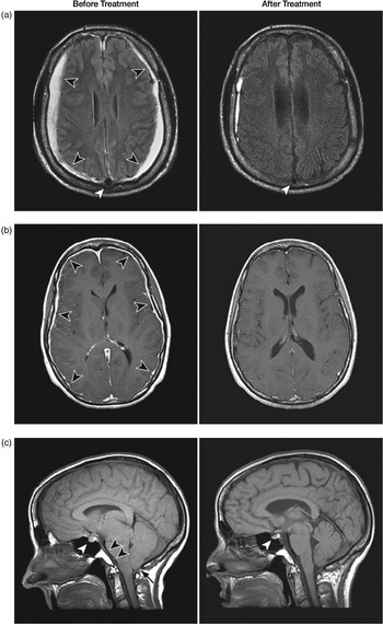 22 – Low-pressure syndromes and cerebrospinal fluid leaks | Neupsy Key