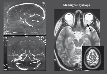 26 – Pseudotumor cerebri syndrome | Neupsy Key