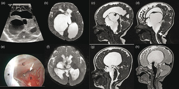 24 – Management of hydrocephalus with associated cerebrospinal fluid ...