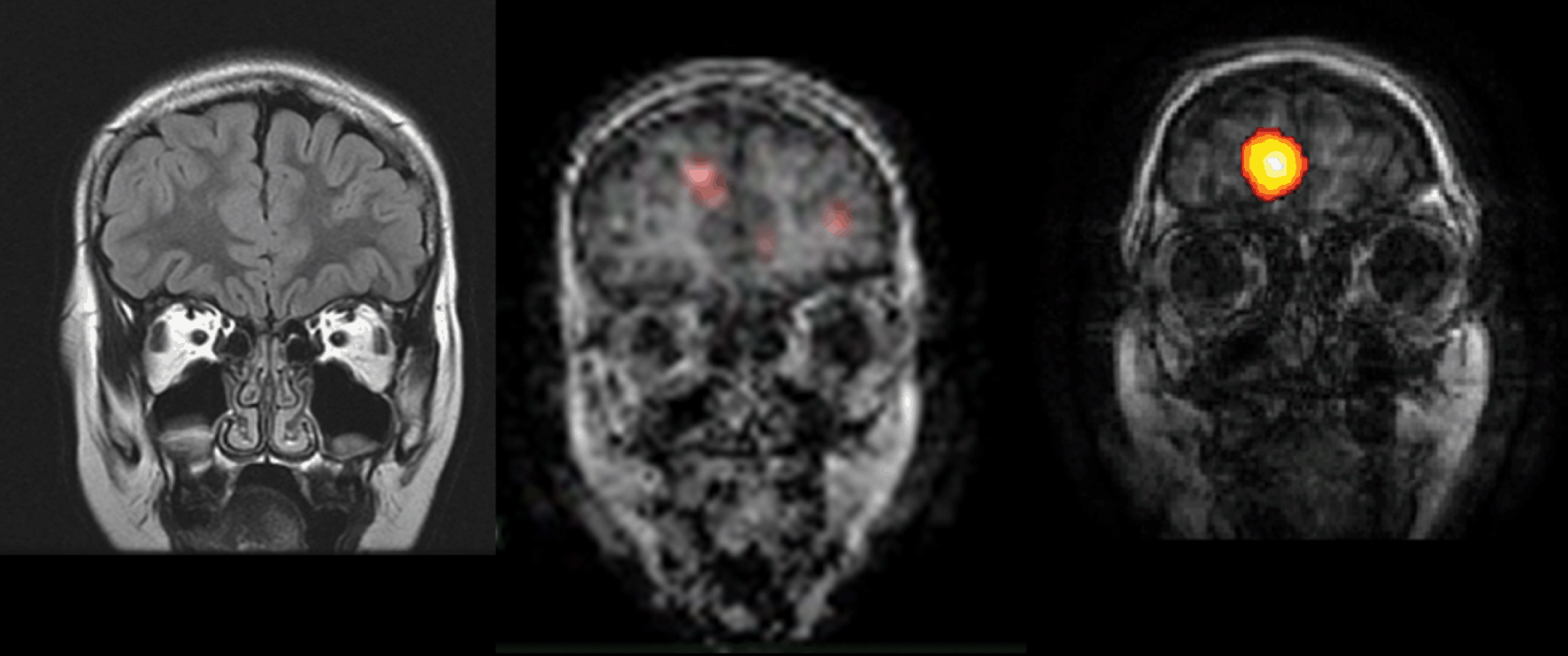 Chapter 11 – Ictal Events Imaged through SPECT | Neupsy Key