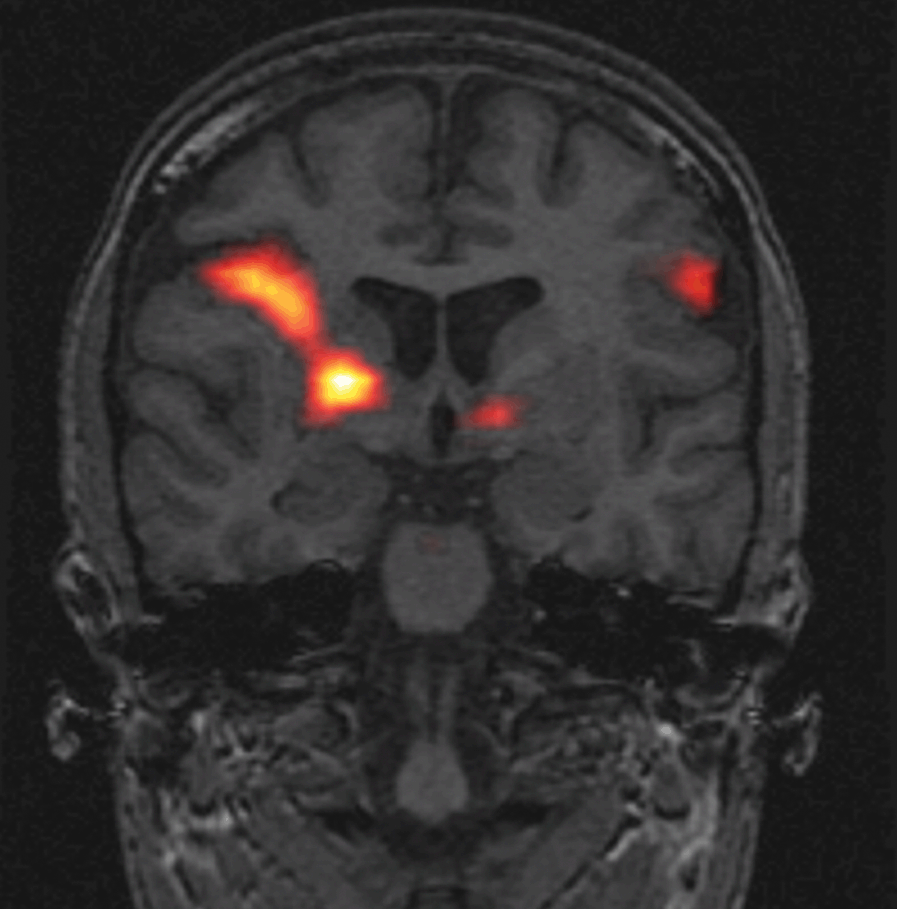 Chapter 11 – Ictal Events Imaged through SPECT | Neupsy Key