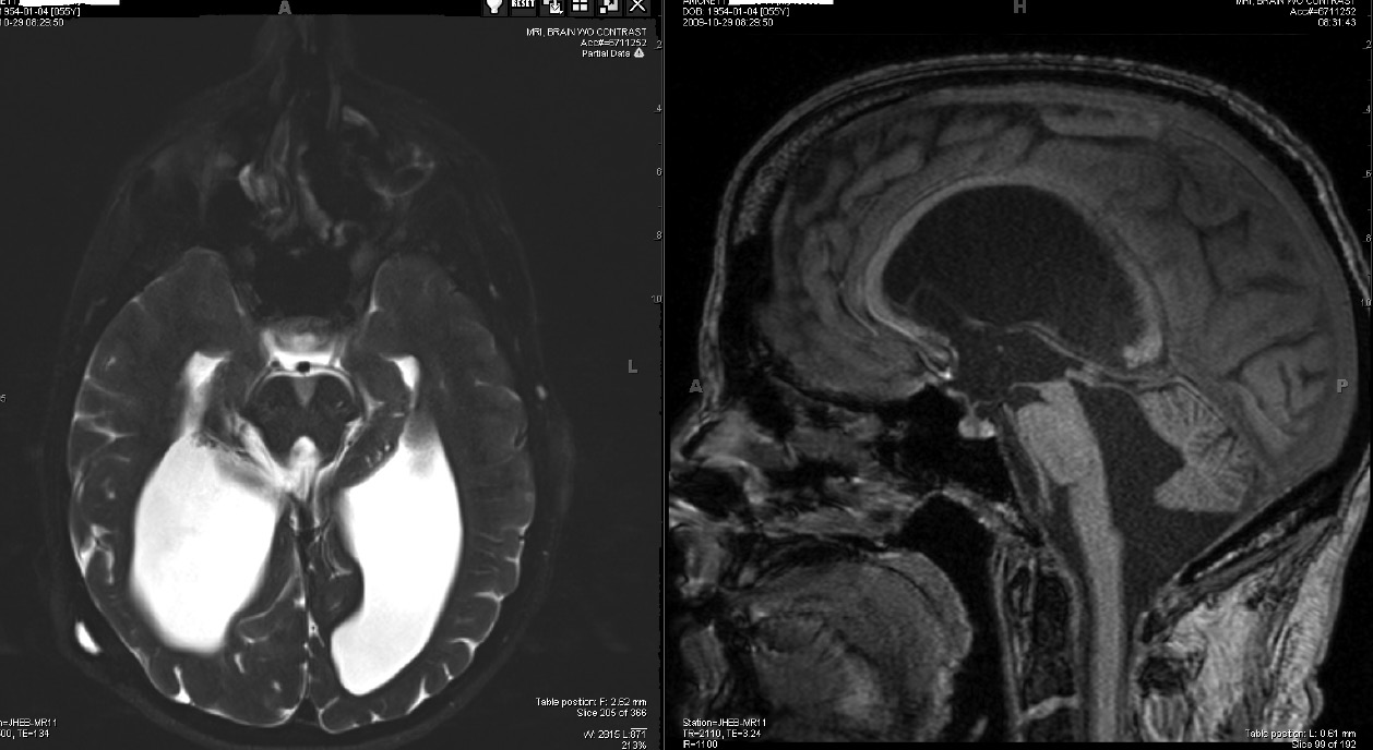 21 – Normal pressure hydrocephalus syndrome secondary to hemorrhage ...