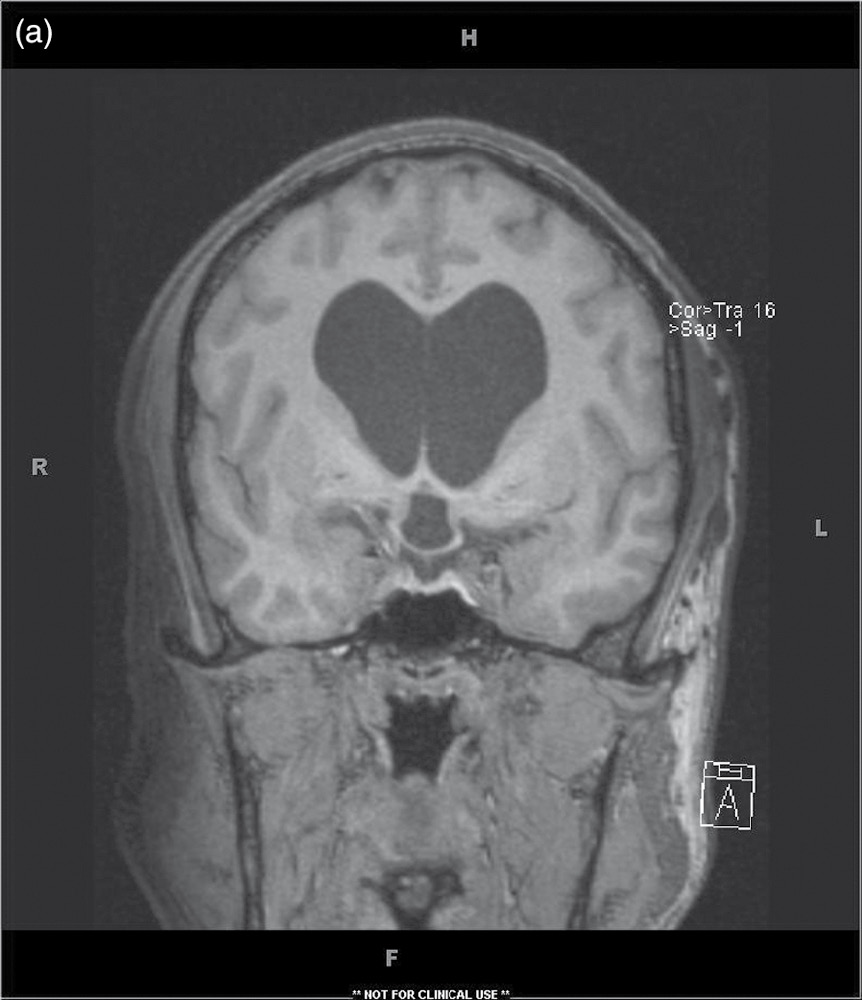 10 – The differential diagnosis of normal pressure hydrocephalus ...