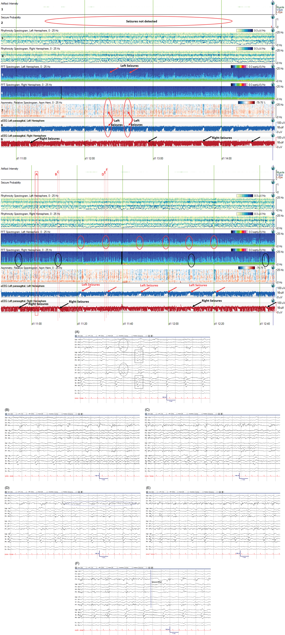 Quantitative Eeg Basics Seizure Detection And Avoiding Pitfalls